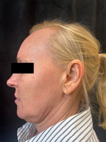 Best Mini Facelift Surgeon Raleigh, NC | Dr. Sumeet Jindal