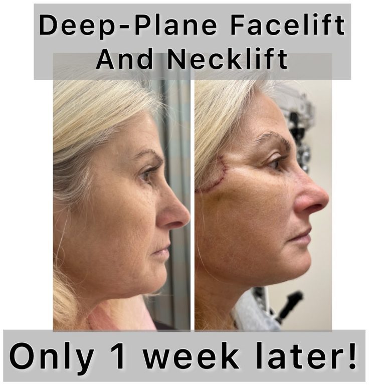Deep Plane Facelift Raleigh, North Carolina | Dr. Jindal