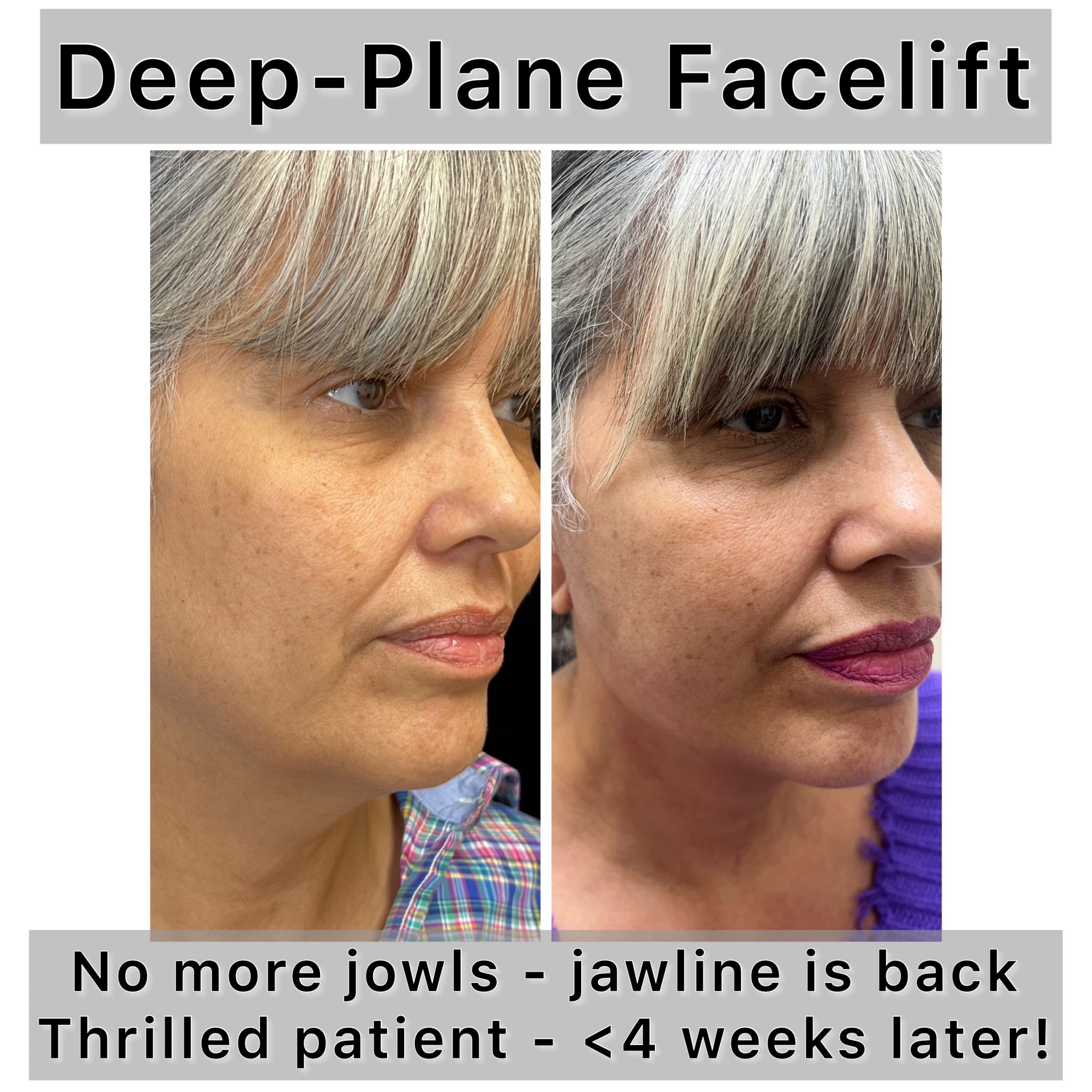 Deep Plane Facelift Raleigh, North Carolina | Dr. Jindal