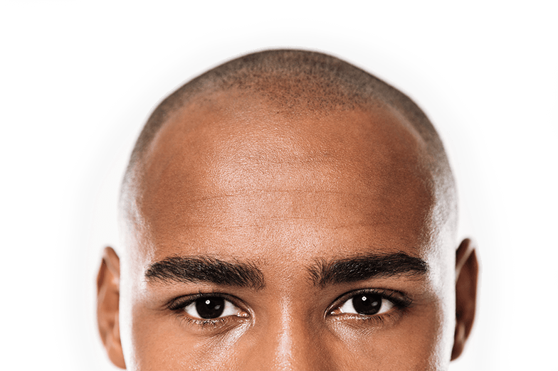 Best Scalp Micropigmentation in Raleigh, NC | Dr. Jindal
