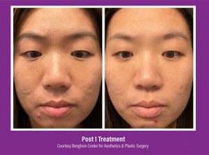 UltraClear Laser Raleigh, NC | Dr. Jindal