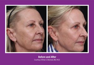 UltraClear Laser Raleigh, NC | Dr. Jindal