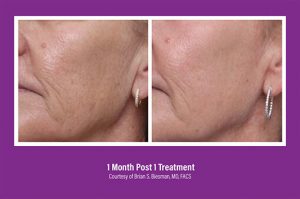 UltraClear Laser Raleigh, NC | Dr. Jindal