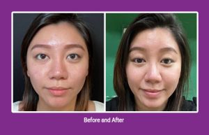 UltraClear Laser Raleigh, NC | Dr. Jindal