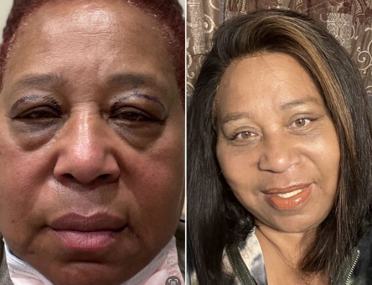 Lower Blepharoplasty Raleigh, NC | Raleigh Eye Lift